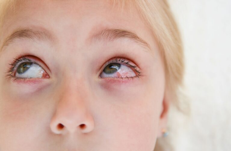 What Can Cause Red Eyes in Children