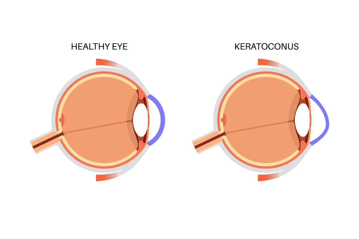 Can Keratoconus Cause Blindness?